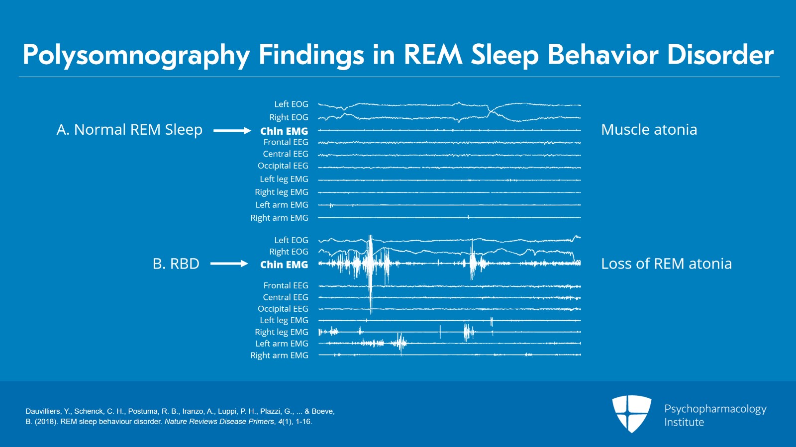 Diagnosing REM Sleep Behavior Disorder | Psychopharmacology Institute
